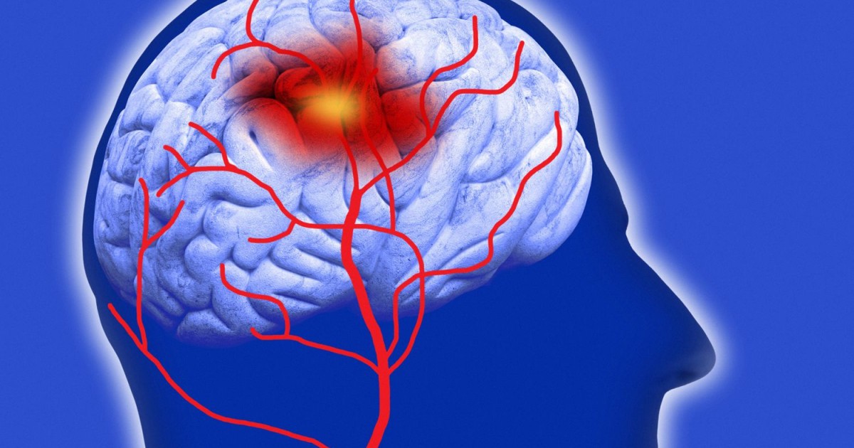 Las 5 diferencias entre incidente cerebrovascular isquémico y ...