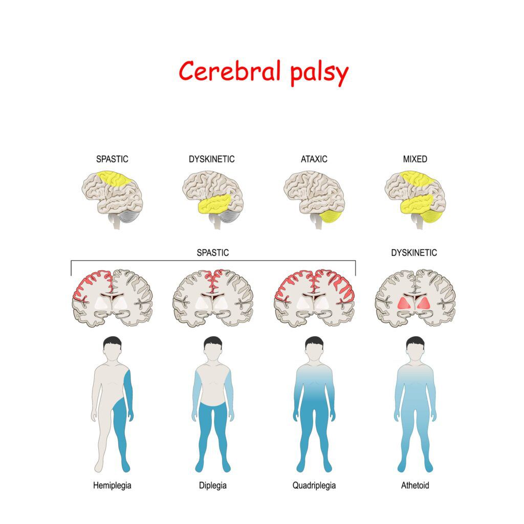 ¿Qué es la Parálisis Cerebral? - Centro Premier de Neurología y ...